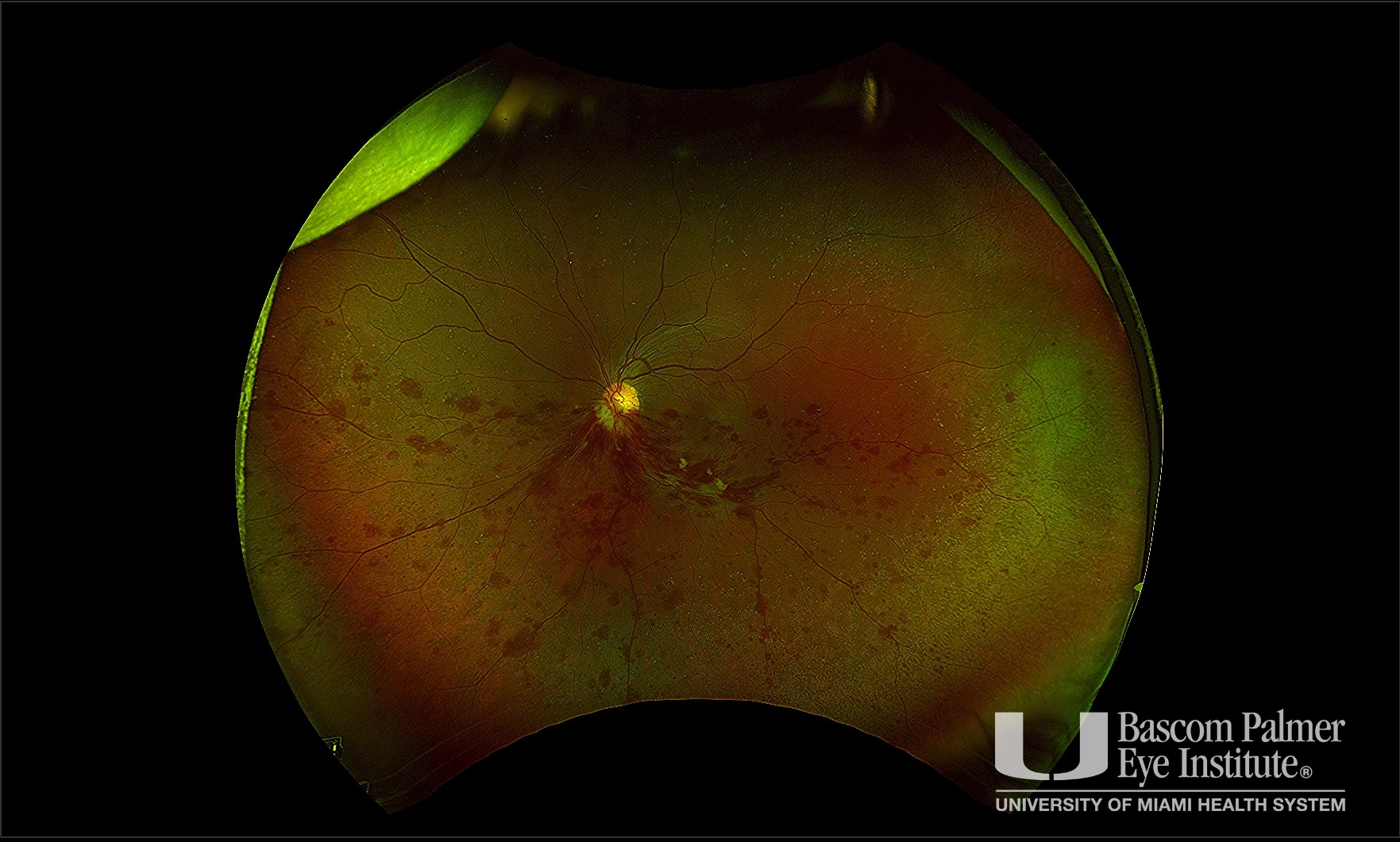 Course Caffeine Associated Hemi Retinal Vein Occlusion Of The Left Eye Course Caffeine Associated Hemi Retinal Vein Occlusion Of The Left Eye